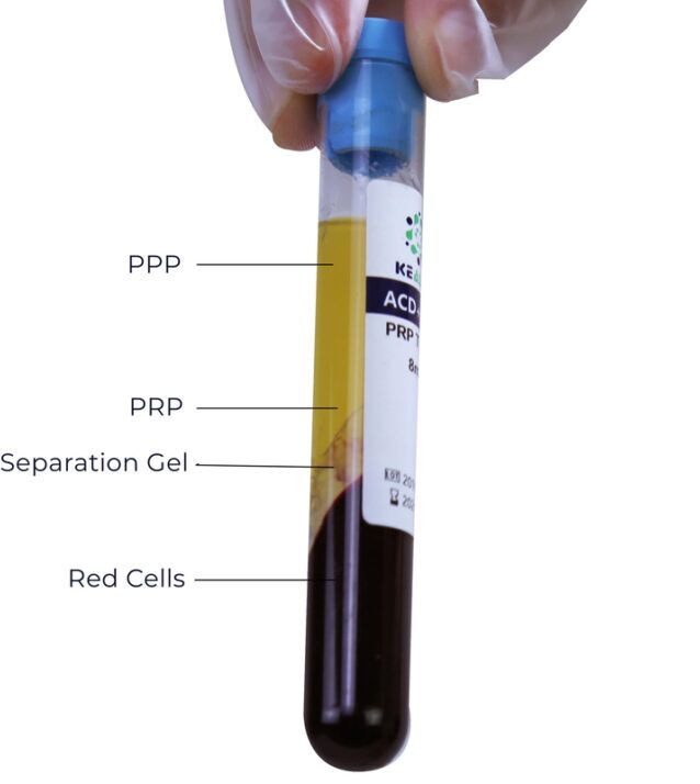 Platelet Rich Plasma Kit | PRP KIT, PRP TUBE, Platelet Rich Plasma ...