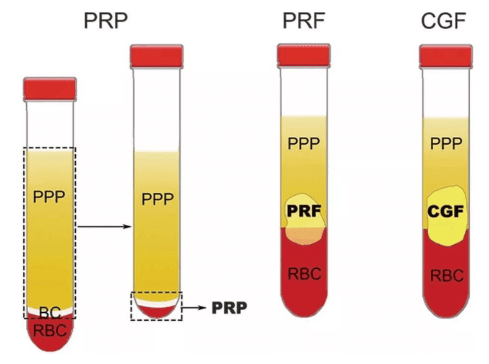 Differences and clinical applications of PRP, APRF, iPRF, CGF | PRP KIT ...