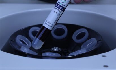 PRP Preparation Procedure | PRP KIT, PRP TUBE, Platelet Rich Plasma ...