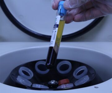 PRP Preparation Procedure | PRP KIT, PRP TUBE, Platelet Rich Plasma ...